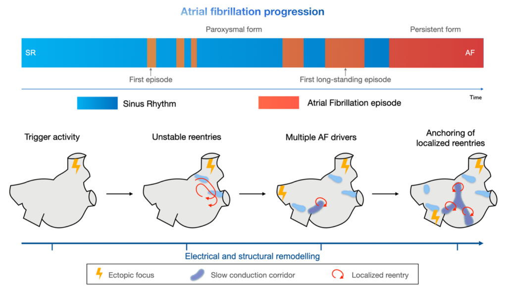 Precision Medicine to Control Atrial Fibrillation Progression